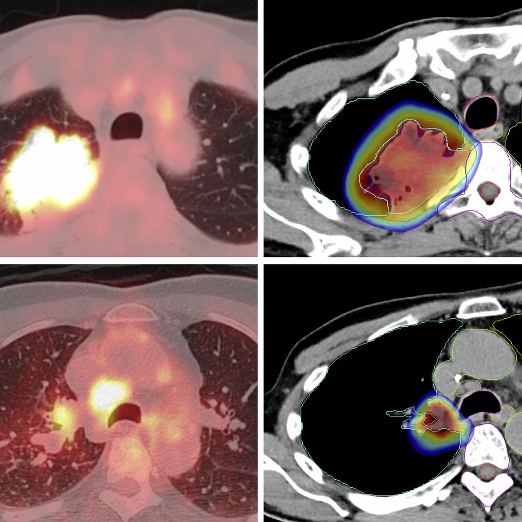 NSCLC im Stadium III: Rolle der Strahlentherapie im Zeitalter der Immu - Onkologie - Universimed ...